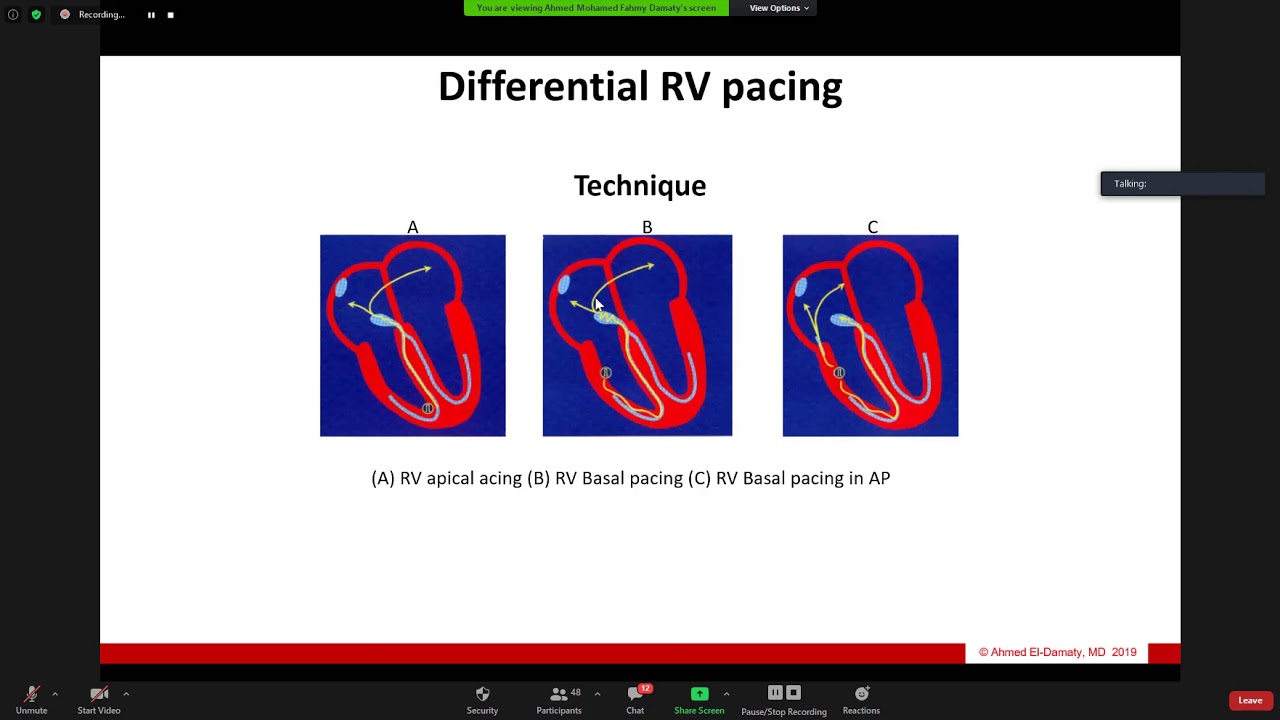 pacing maneuvers in the EP Laboratory - Dr. Ahmed El- Damaty - YouTube