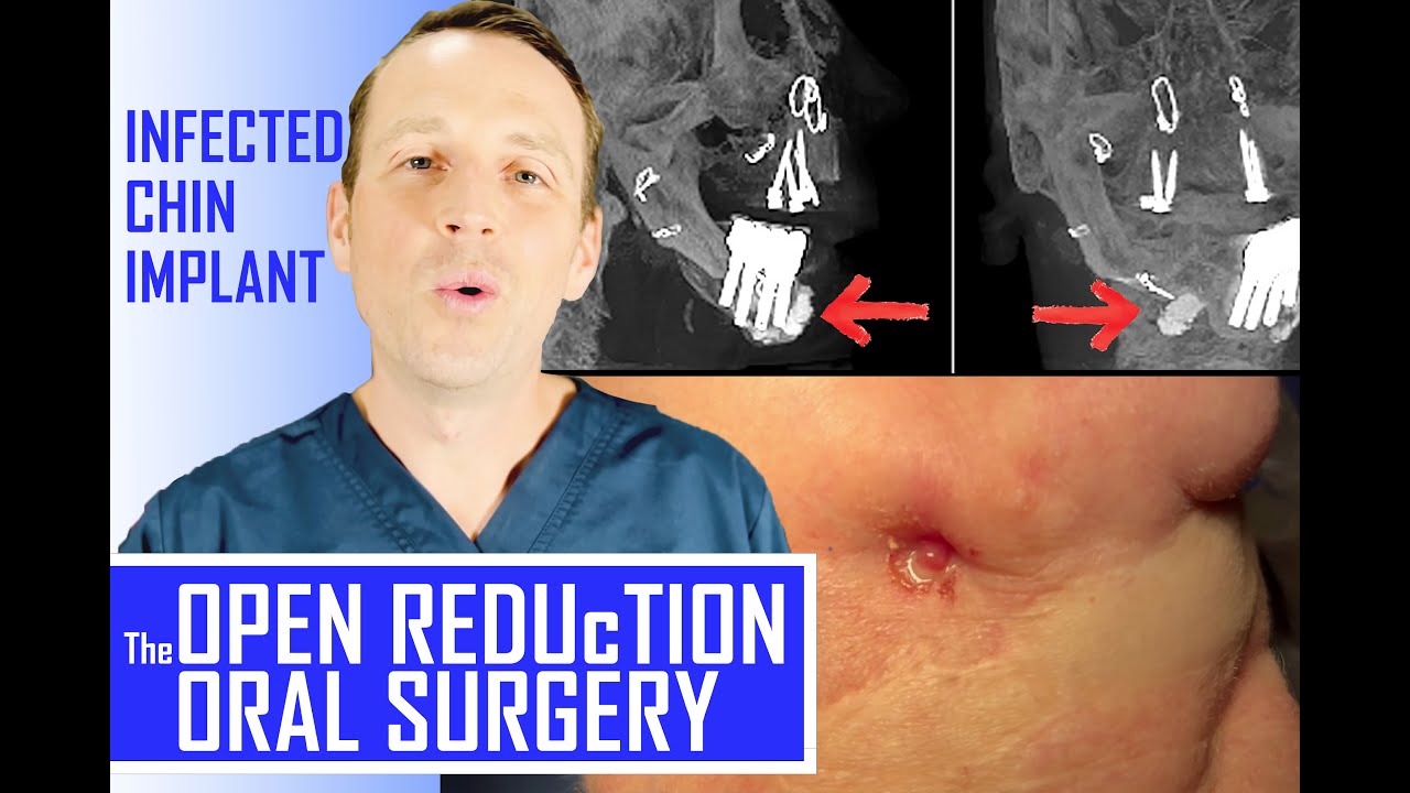 SURGICAL REMOVAL OF AN INFECTED CHIN IMPLANT - YouTube