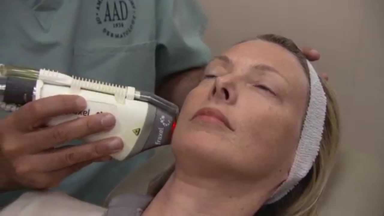 Remove Sun Damage with Fraxel Laser - YouTube