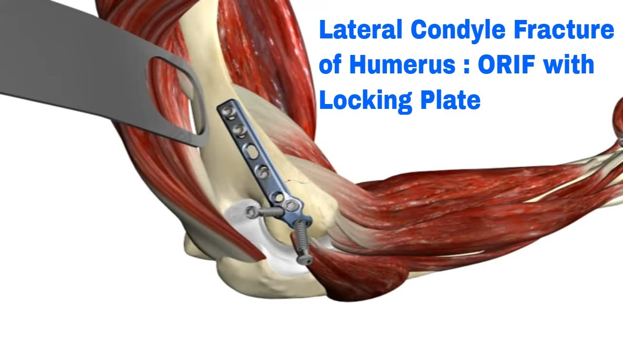 humerus lateral condyle fracture - reduction and fixation with plate ...