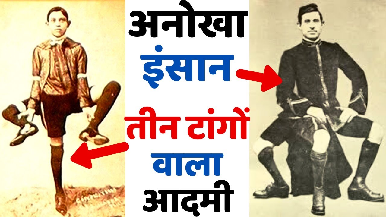 अनोखा इंसान | तीन टांगों वाला आदमी | Story Of Three Legged Man Frank ...