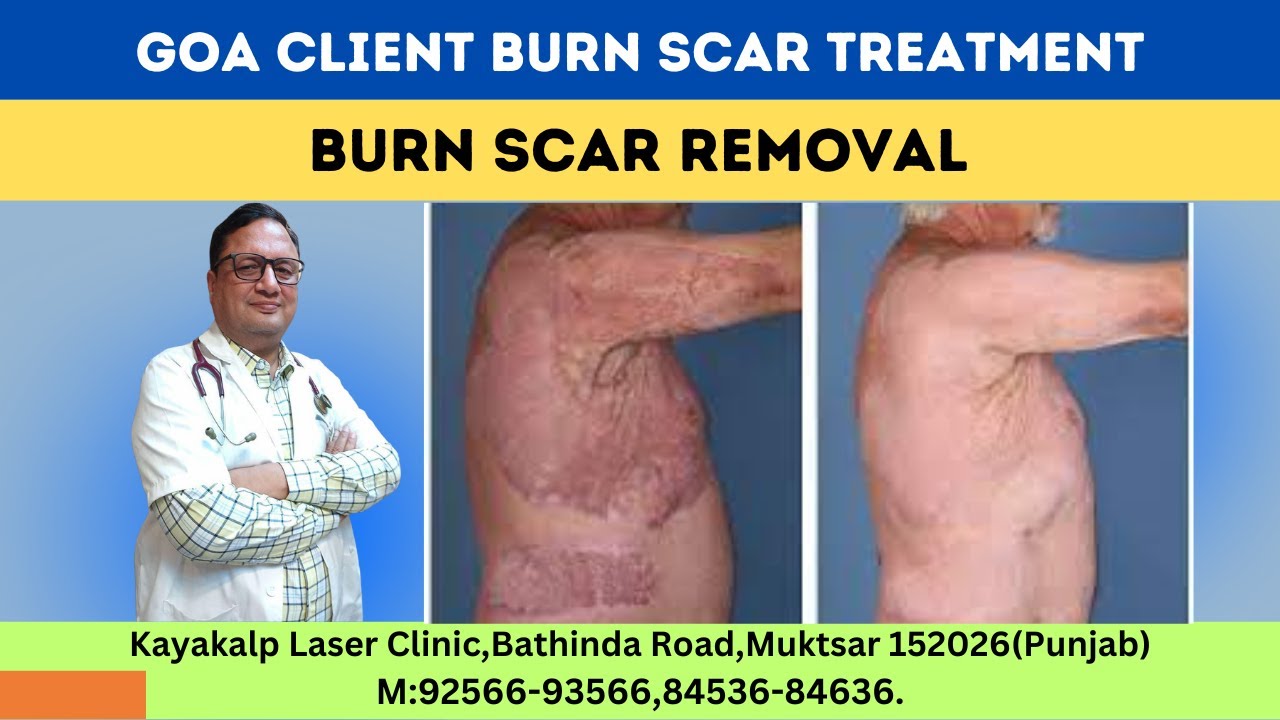 Goa Client Burn Scar Treatment | Burn Scar Removal | Kayakalp Laser ...