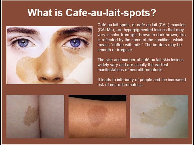 Cafe Au Lait Spots Cause