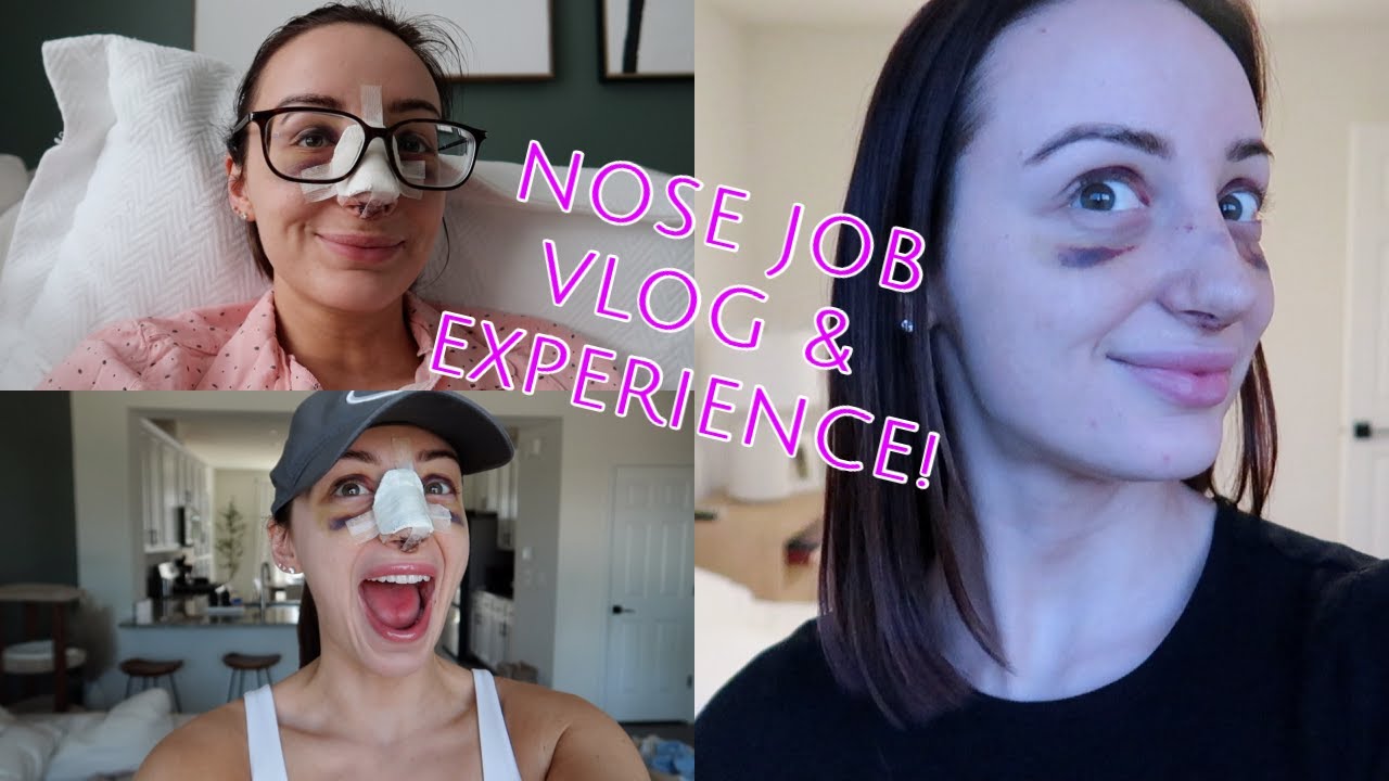 I GOT A NOSE JOB! Septo-Rhinoplasty Vlog & Experience! - YouTube
