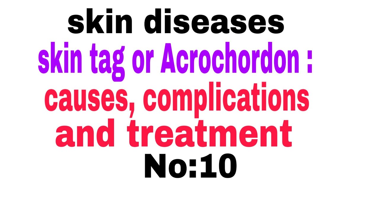 Skin tag or Acrochordon. Skin diseases - YouTube