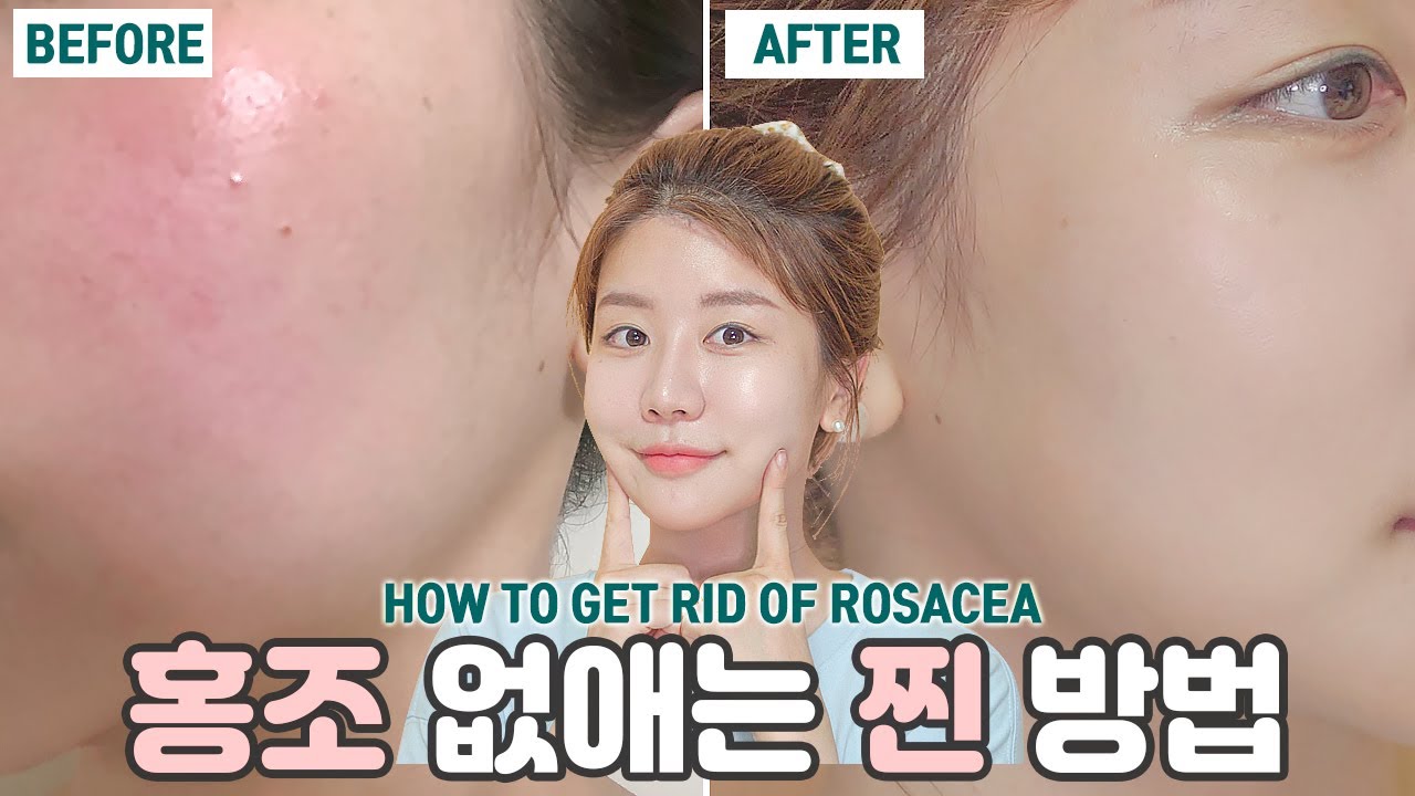 ENG) 홍조 없애는 방법 ️ 오래 기다리신 만큼 확실한 찐 치료 방법 알려드려요🧐 How To Get Rid Of ...
