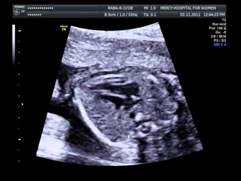 Double discordance (congenitally corrected transposition of the great ...