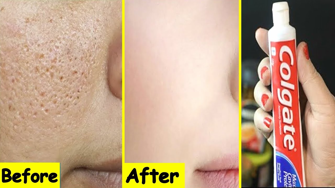 Skin Whitening Colgate Home Toothpaste Treatments Pure Beauty Tips ...