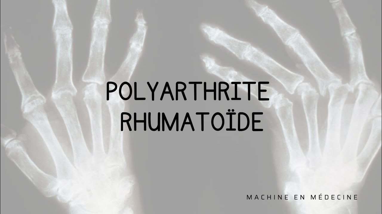 Polyarthrite Rhumatoïde (PR) - YouTube