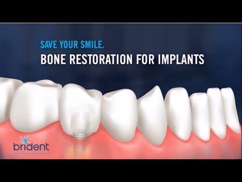 Rebuild Your Smile with Bone Restoration for Implants | Brident Dental ...
