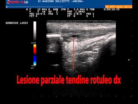 Tendine rotuleo dx lesione parziale - YouTube