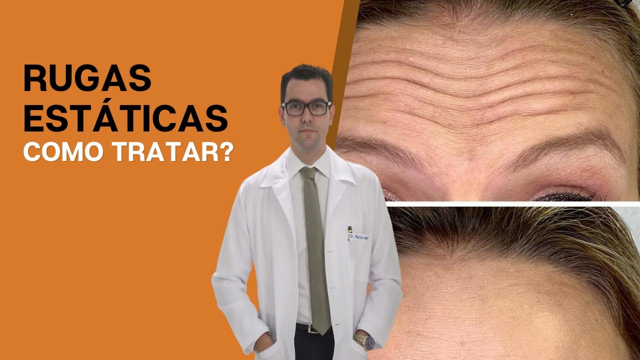Rugas estáticas: Como tratar? - YouTube