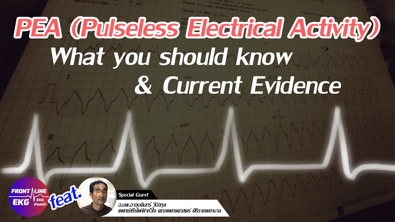ขาน PEA แต่ต้องคิดมากกว่า PEA | feat. อ.อาจบดินทร์ | Frontline EKG ...