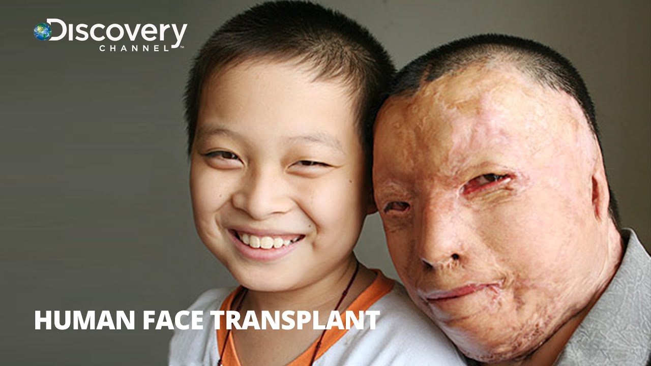 Human Face Transplant - Discovery - YouTube