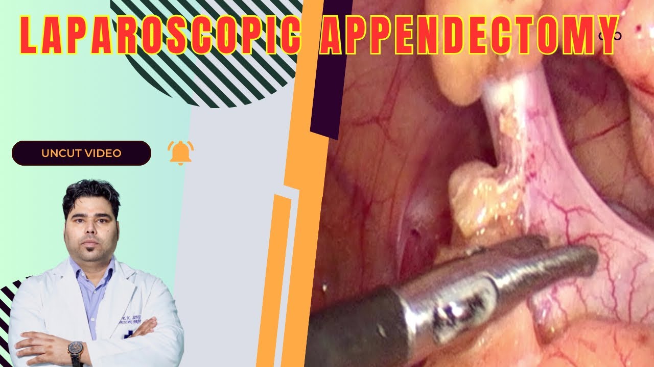 Laparoscopic appendectomy detailed surgery video - YouTube