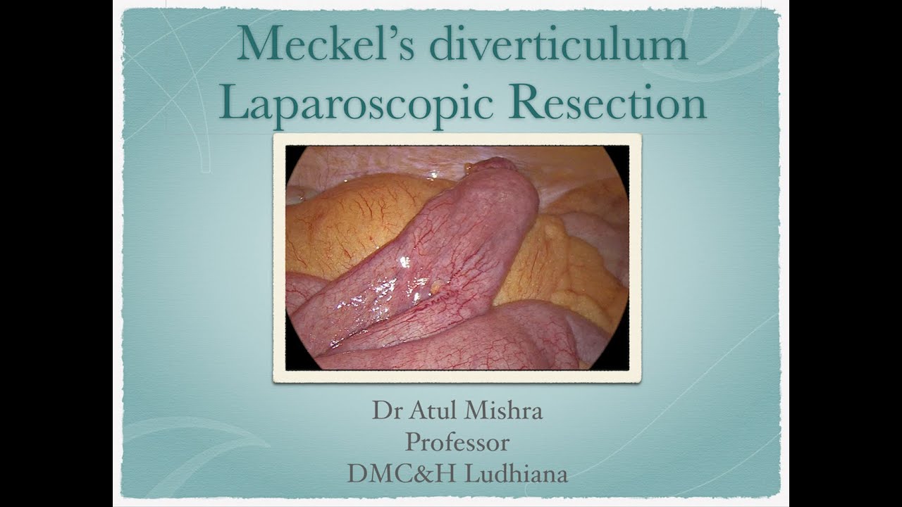 Meckel's Diverticulum: Laparoscopic resection - Dr Atul Mishra ...