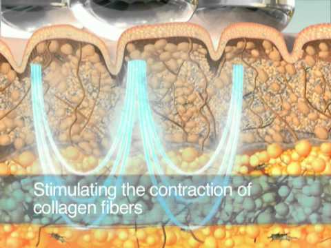 Tripollar apollo for body contouring, facial sculpting, fat reduction ...