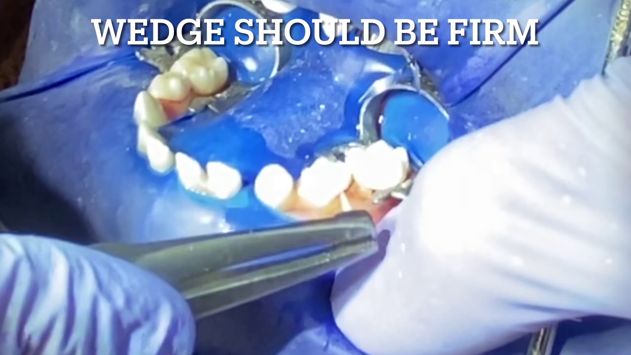 Dental Assistant Training - Placing a wedge - YouTube