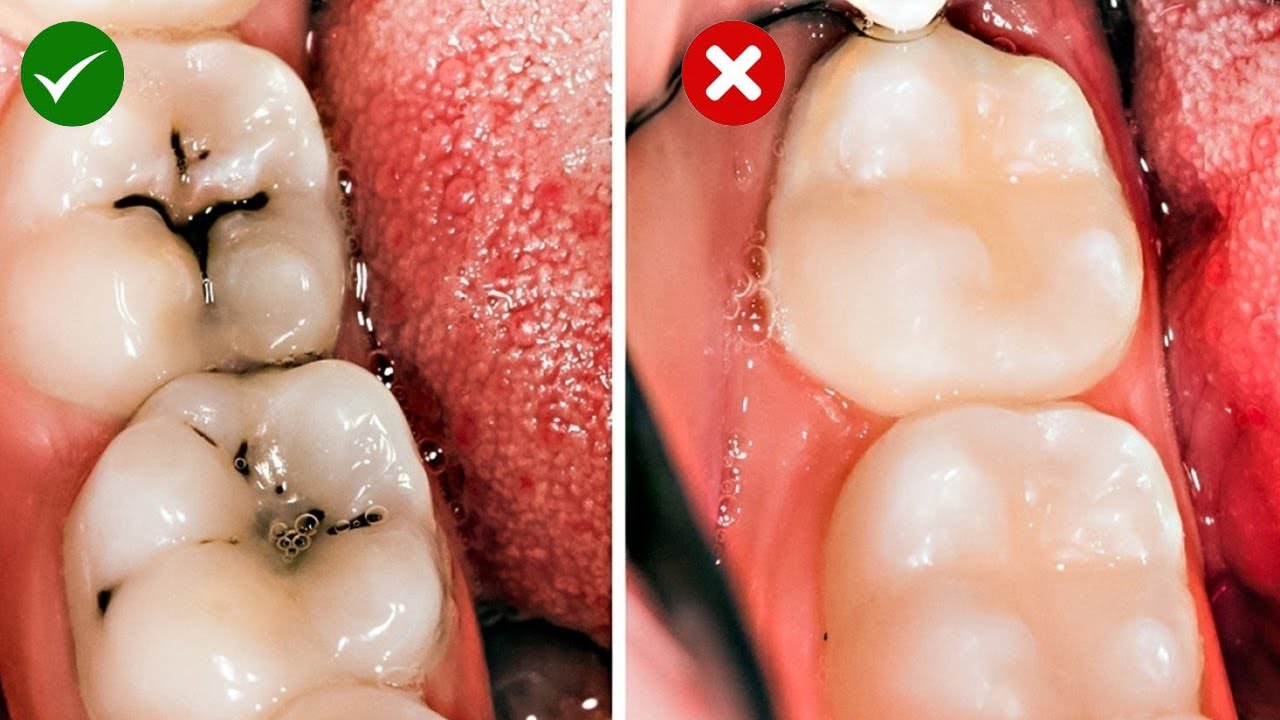 Turn Yellow Teeth Into Pearl White | How To White Your Teeth | 5 ...