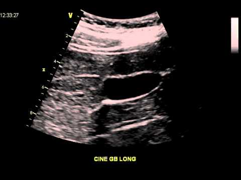 gallbladder cine loop - YouTube