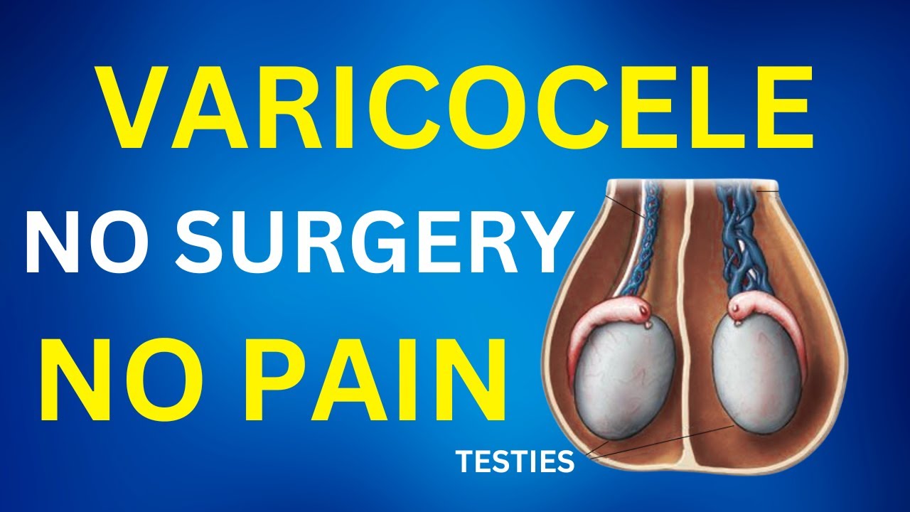 Varicocele Causes Symptoms Treatment Urdu | Left Testicle Pain ka ilaj ...