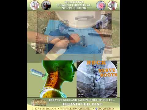 Cervical transforaminal block for neck pain relief - YouTube