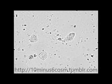 Trichomonas vaginalisis Trophozoite in urine sample under microscope ...