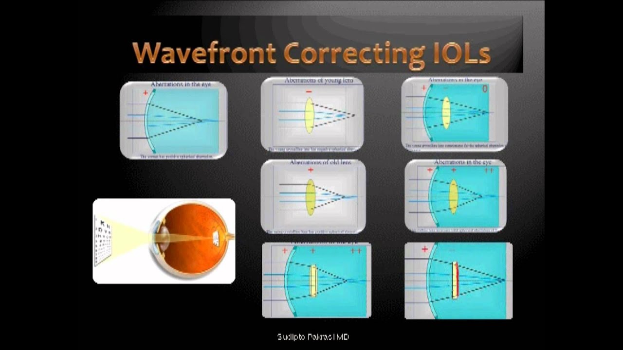 IOL Choices in High end Cataract Surgery .. part 1 of 3.wmv - YouTube