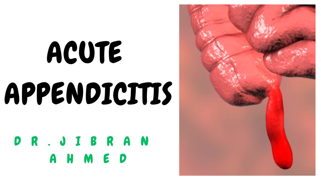 ACUTE APPENDICITIS II SYSTEMIC PATHOLOGY II ROBBINS - YouTube