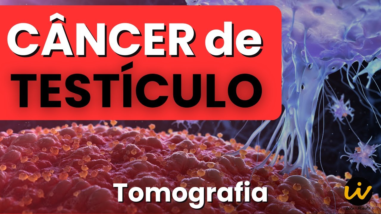 Ultrassom De Cancer Testicular Testicular Cancer Imaging | Radiology