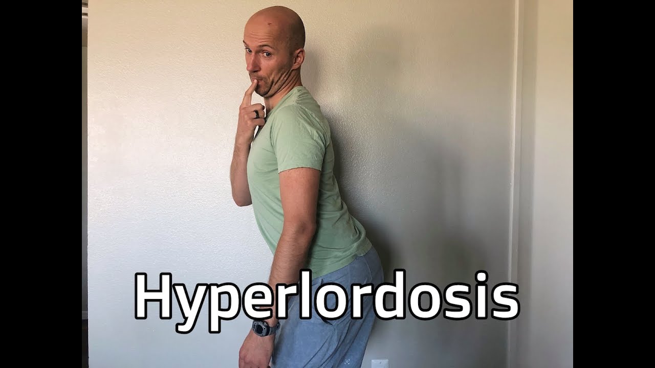 Hyperlordosis and Rib Flares - YouTube