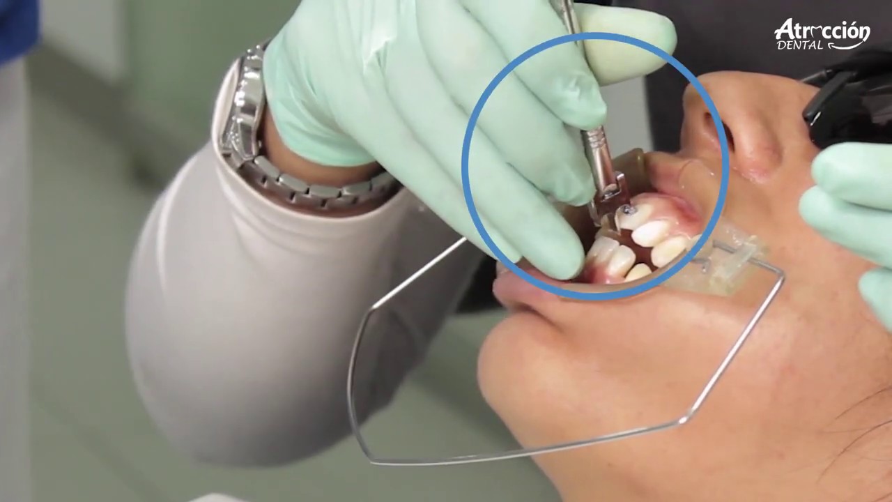 Colocando brackets en 5 pasos - YouTube