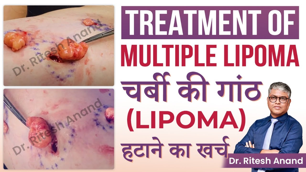 What is the Treatment of Multiple Lipoma? चर्बी की गांठ( Lipoma ) हटाने ...