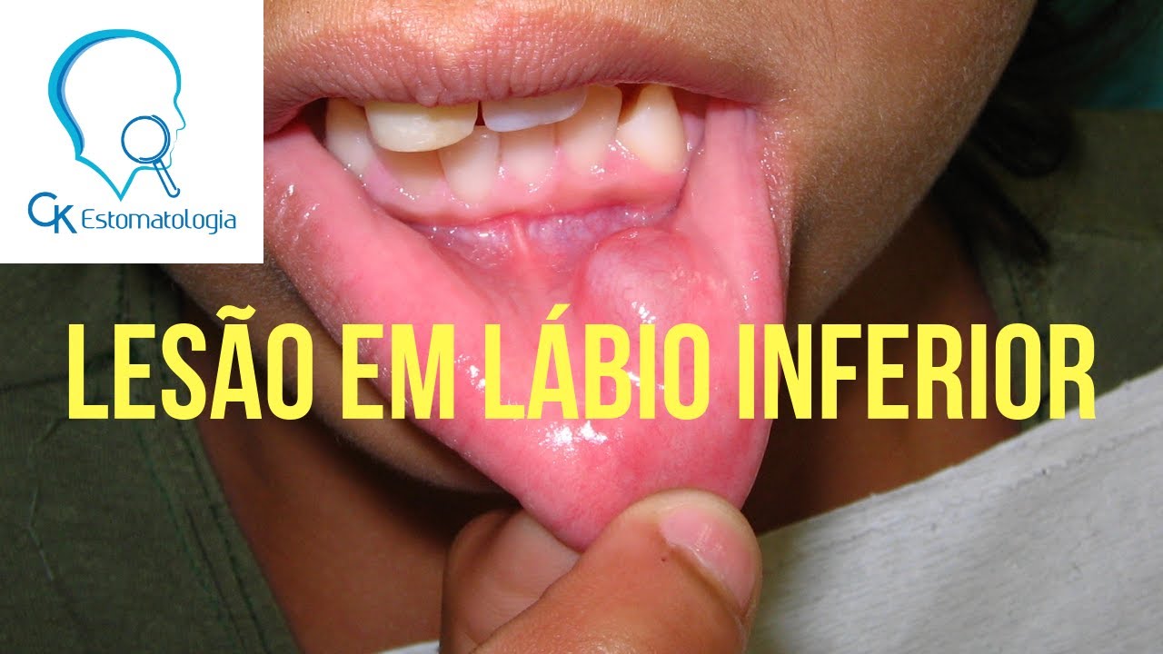 Comentário caso clínico Lesão em lábio inferior - Mucocele - YouTube