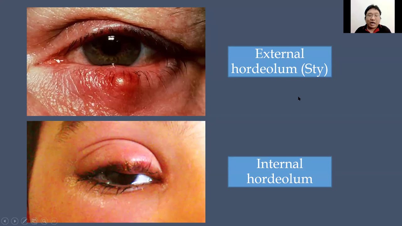 Pathology of the eye - YouTube