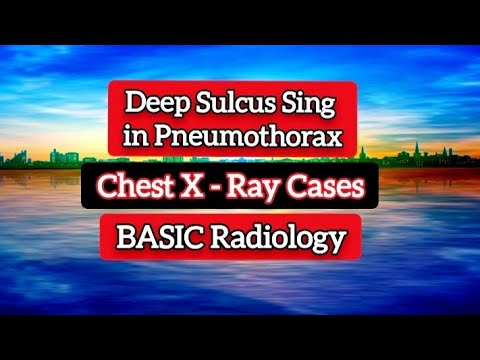 Deep Sulcus Sign - Pneumothorax - Supine X ray - Radiology Review - YouTube