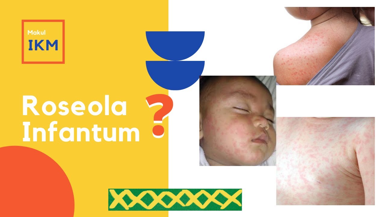 ROSEOLA INFANTUM - ILMU KESEHATAN MASYARAKAT - YouTube