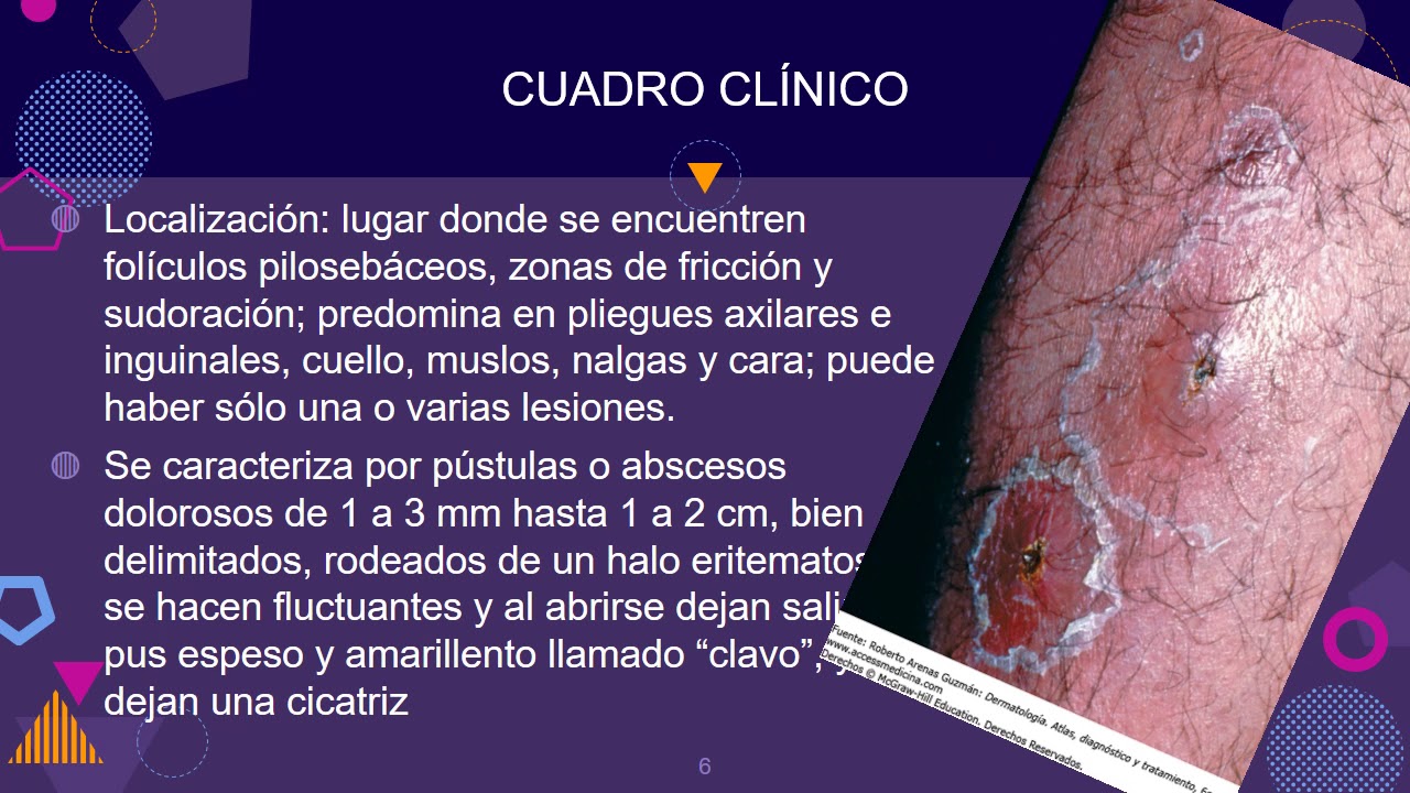 FURUNCULOSIS g5 - YouTube