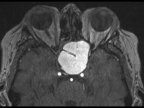 What Is A Sphenoid Sinus Retention Cyst - Infoupdate.org