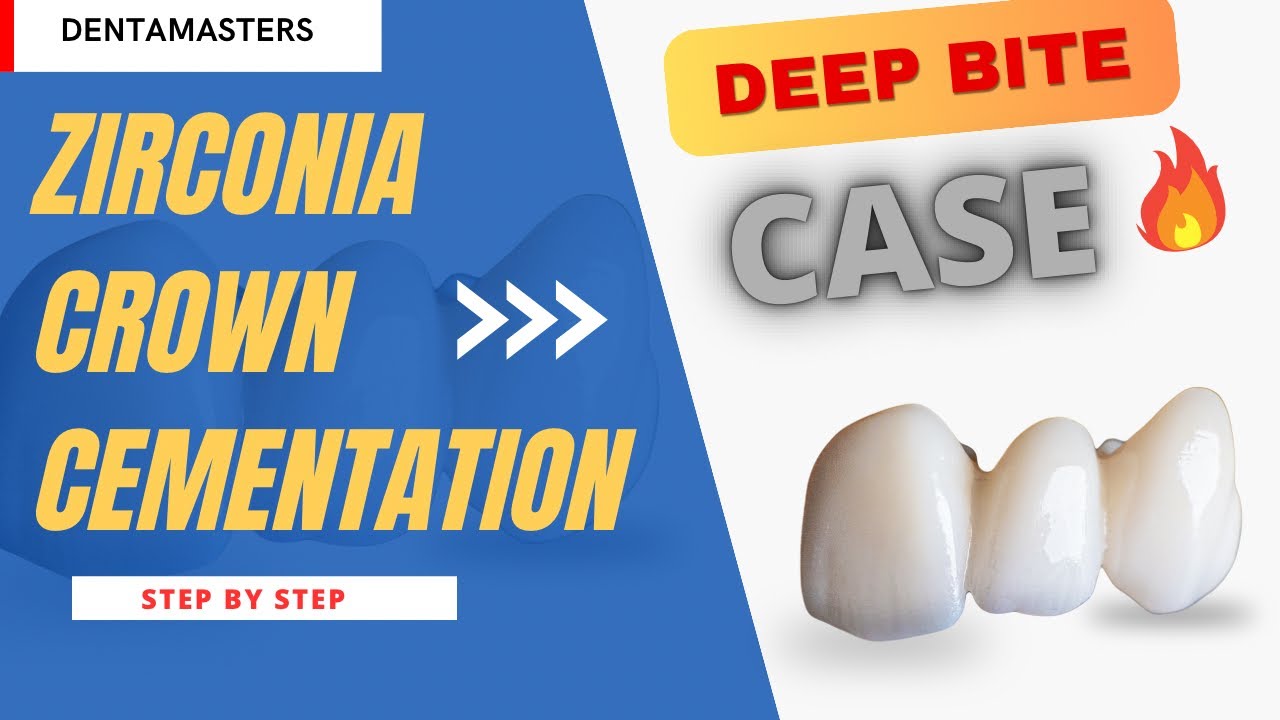 Master Zirconia Crown Cementation: Step-by-Step Guide for Dentists ...