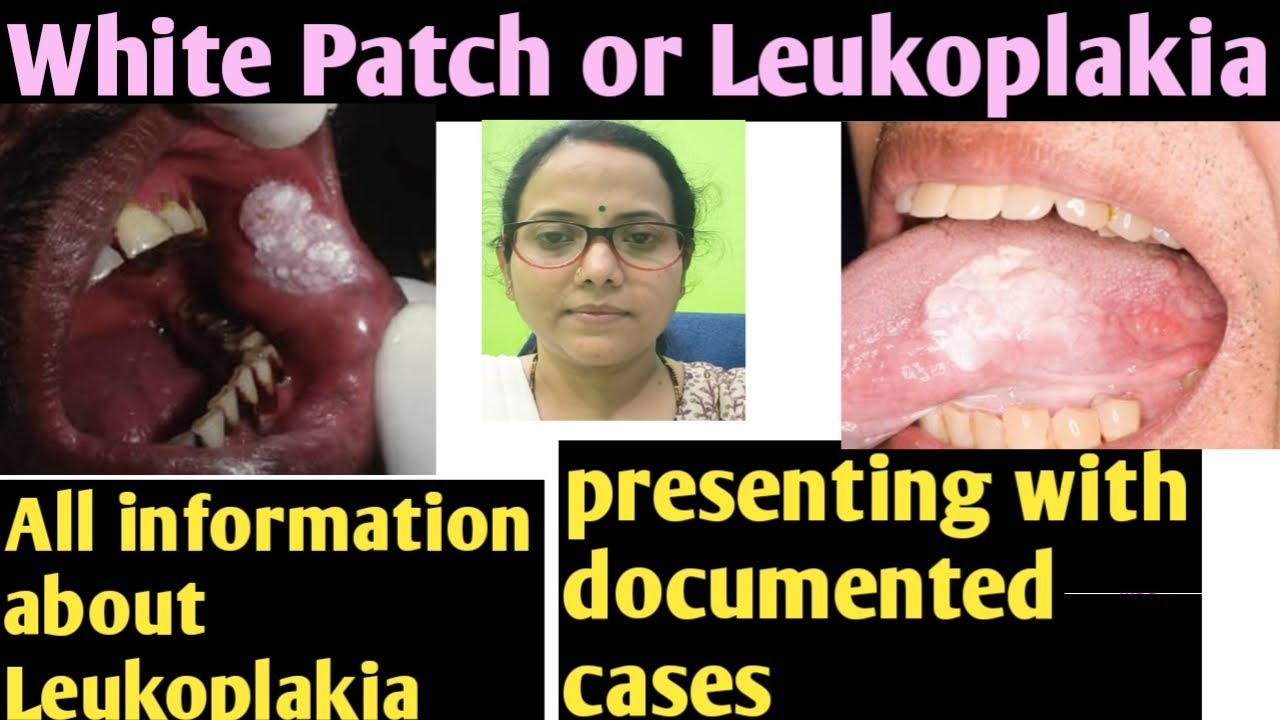 Leukoplakia when become dangerous Leukoplakia when transform to cancer ...