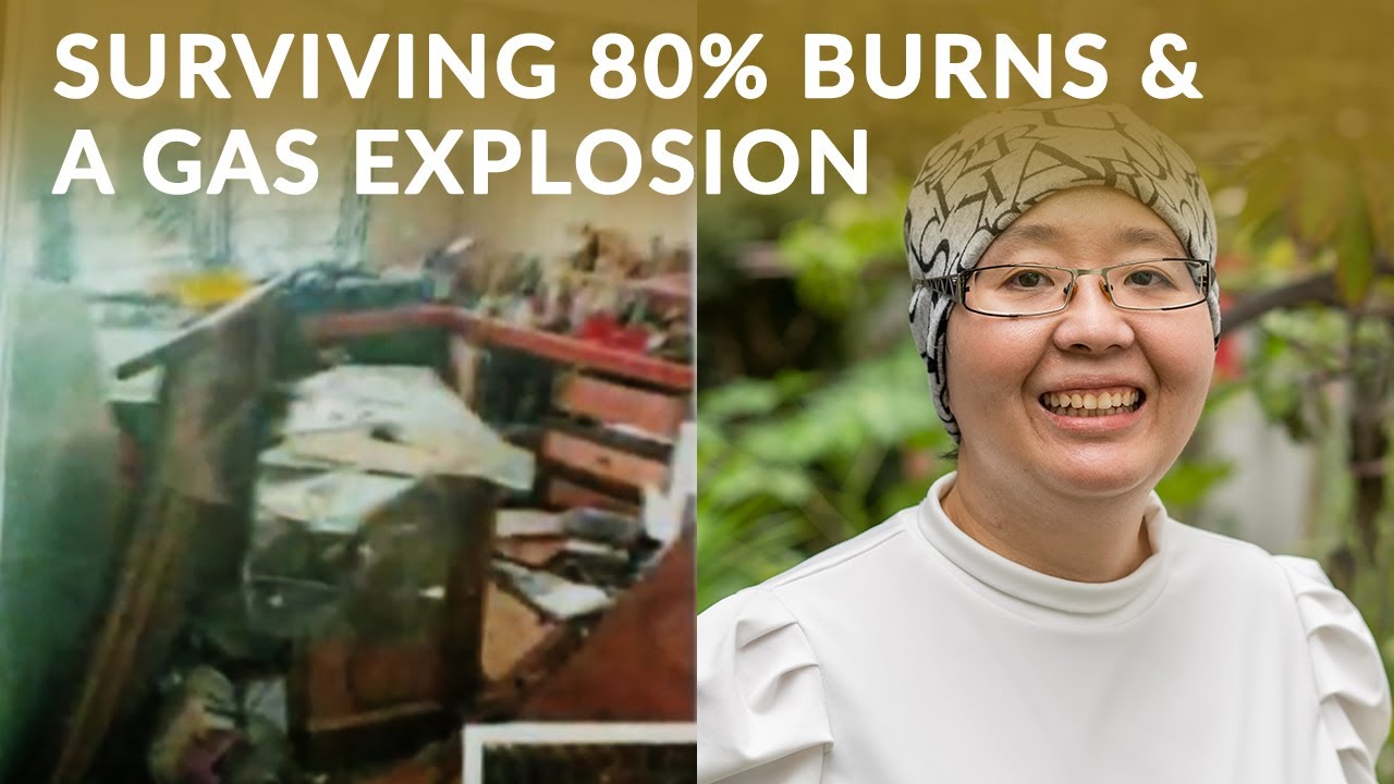 A Burn Survivor's Story: Life After Surviving 80% Burns & a Gas ...