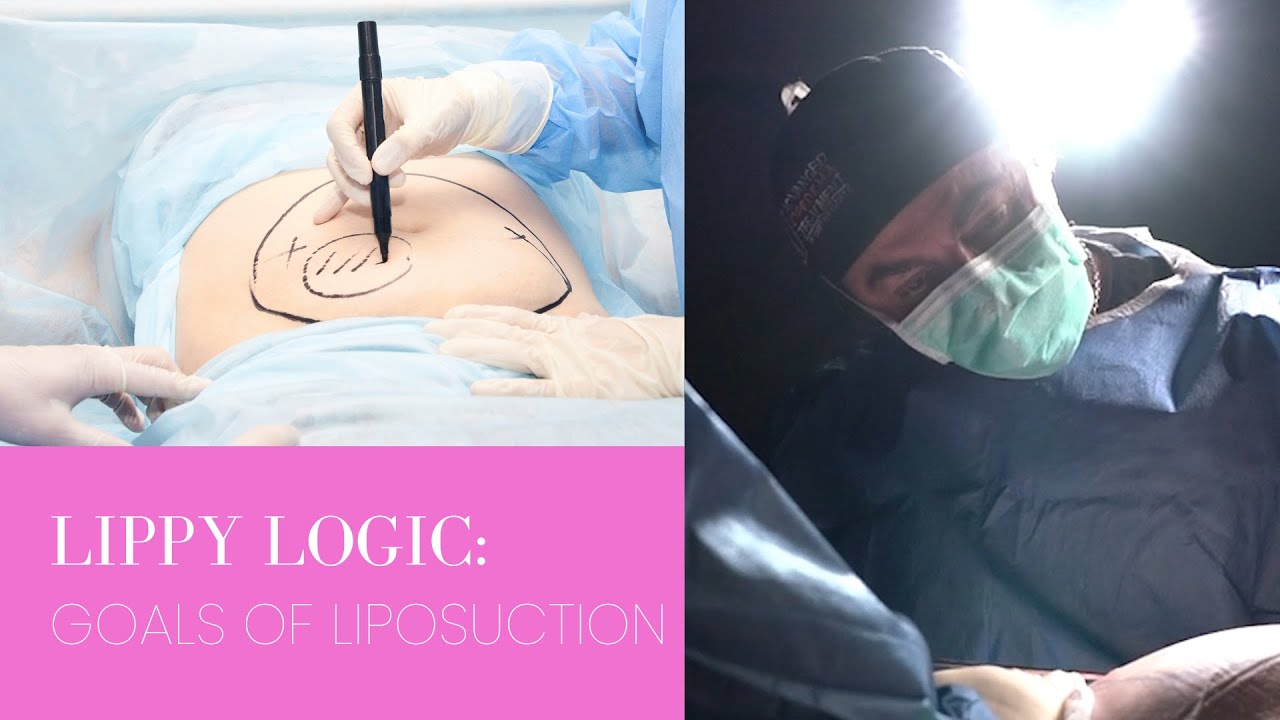 Lippy Logic™ | Episode 8: Goals of Liposuction | Dr. David Amron - YouTube
