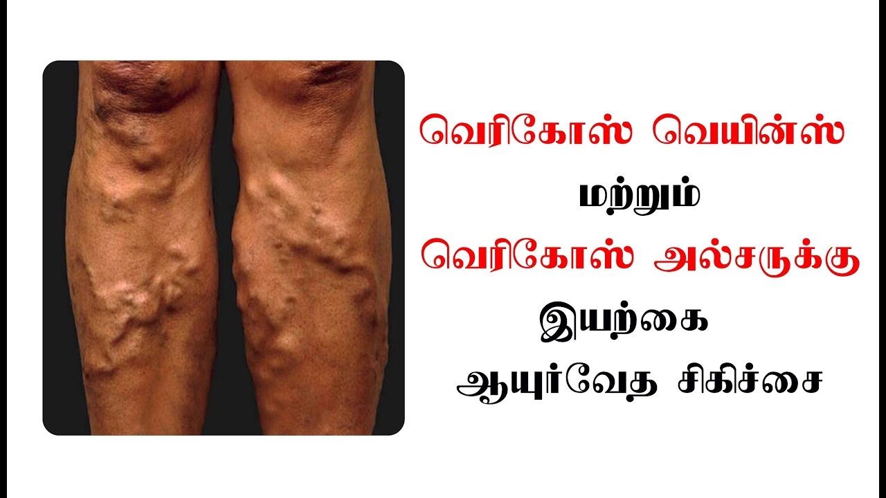 #Natural Healing for Varicose Veins and Ulcer | Dr.K.Gowthaman #Shree ...