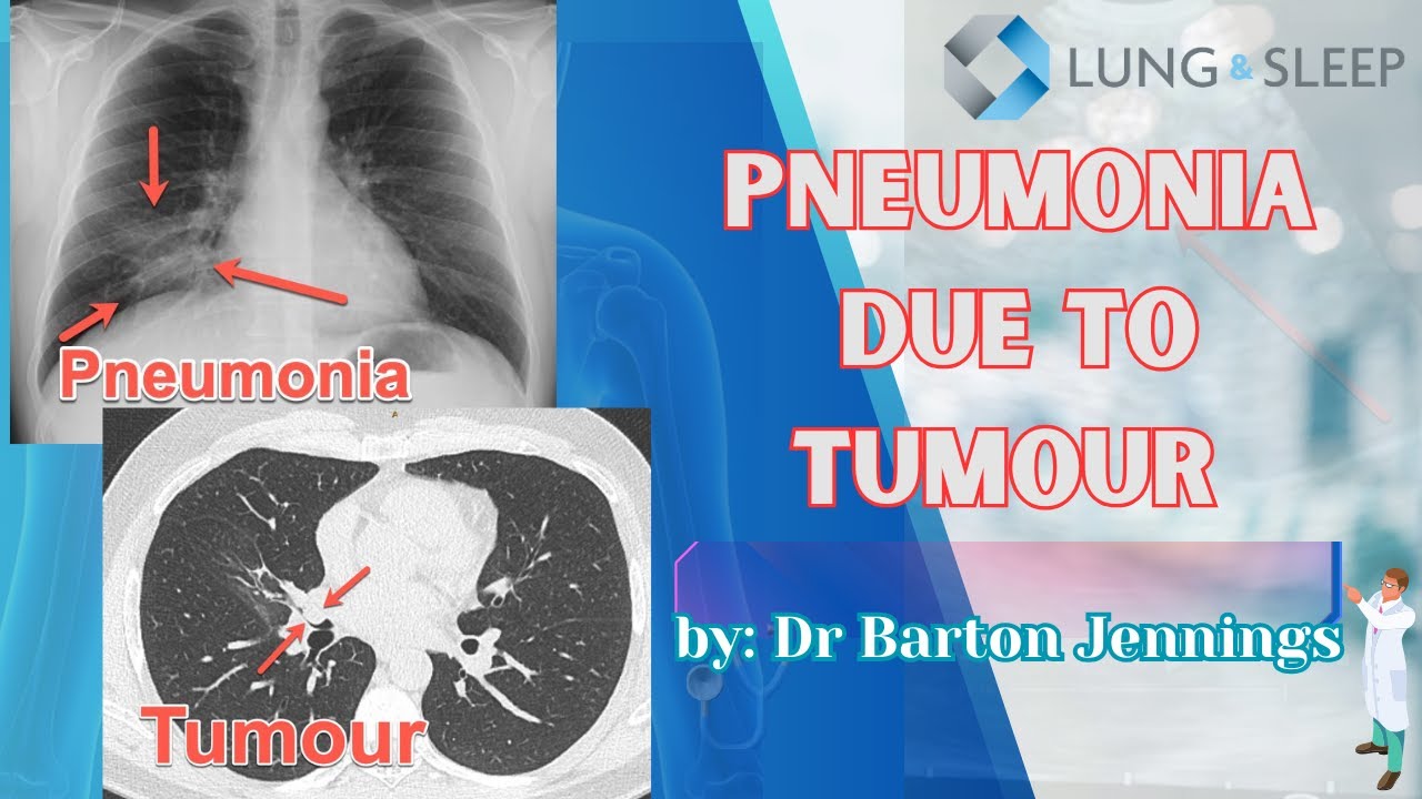 Right middle lobe pneumonia from obstructing tumour - YouTube