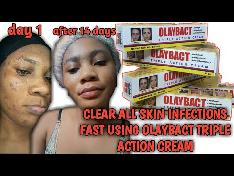 OLAYBACT TRIPLE ACTION CREAM HONEST REVIEW.(My Before And After Use ...