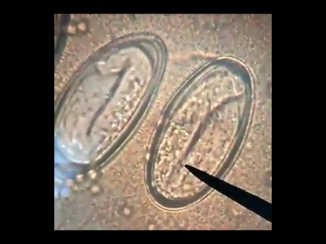 Enterobius Vermicularis Ova Ectopic Enterobiasis: A Case Report And