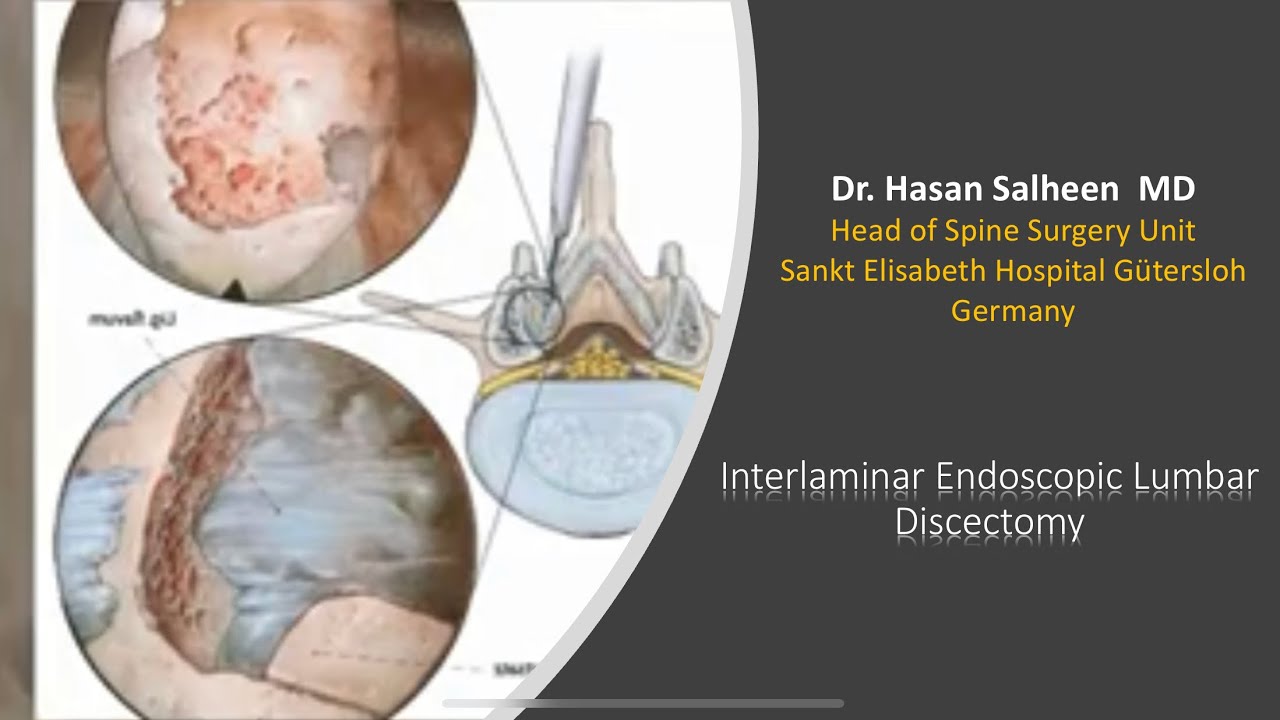 Endoscopic Interlaminar approach - YouTube
