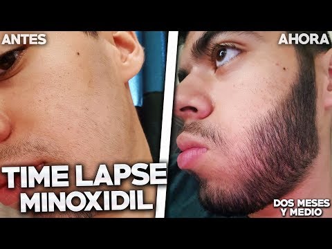 TIME LAPSE DE MINOXIDIL 2 MESES Y MEDIO - YouTube