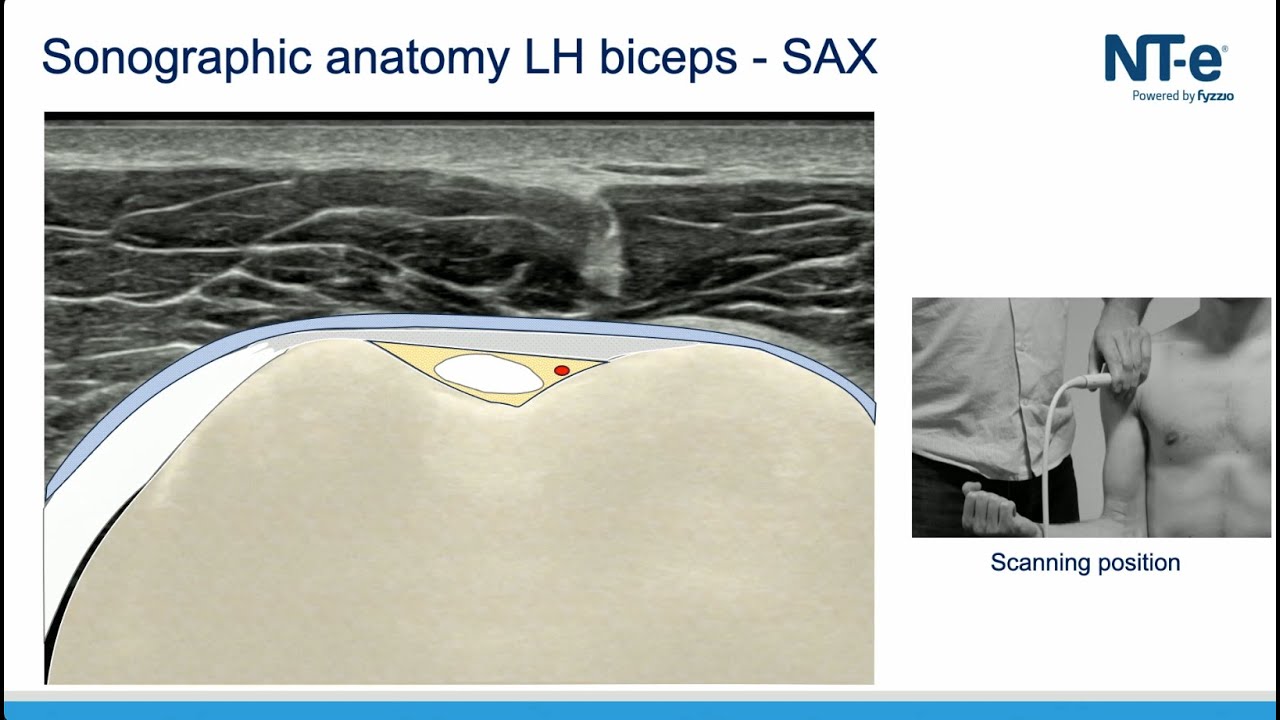 Quick review sono-anatomy biceps in the bicipital groove - YouTube